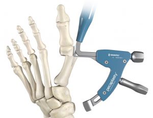 MIS Bunion Correction | Novastep