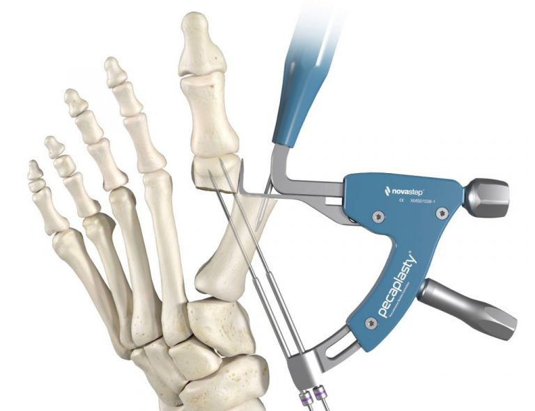 MIS Bunion Correction | Novastep