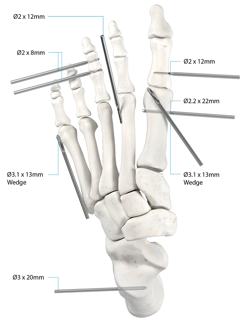 MIS Bunion Correction | Novastep