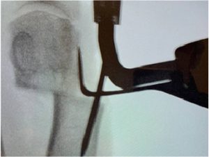 MIS Bunion Correction | Novastep