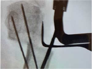 MIS Bunion Correction | Novastep