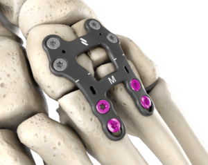 Lisfranc T-Plates | Novastep