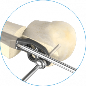 MIS Bunion Correction | Novastep