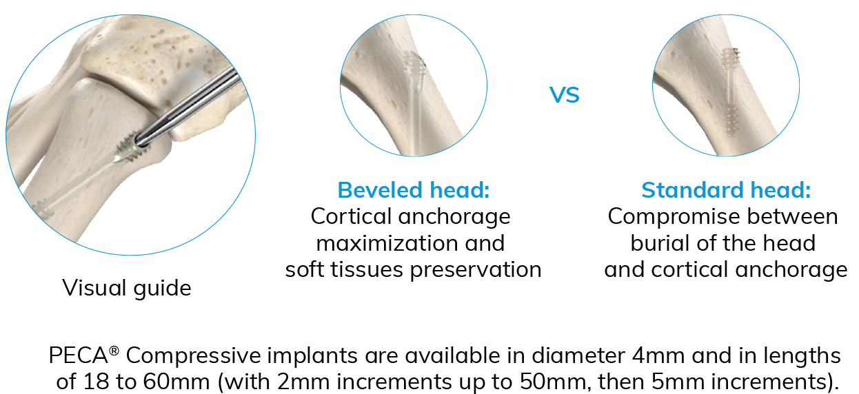 MIS Bunion Correction PECA-C | Novastep