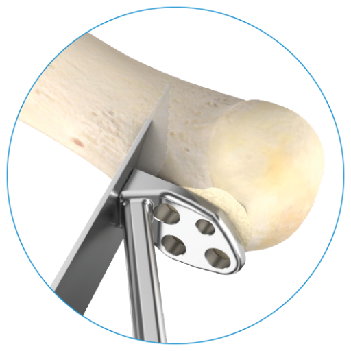 MIS Bunion Correction | Novastep